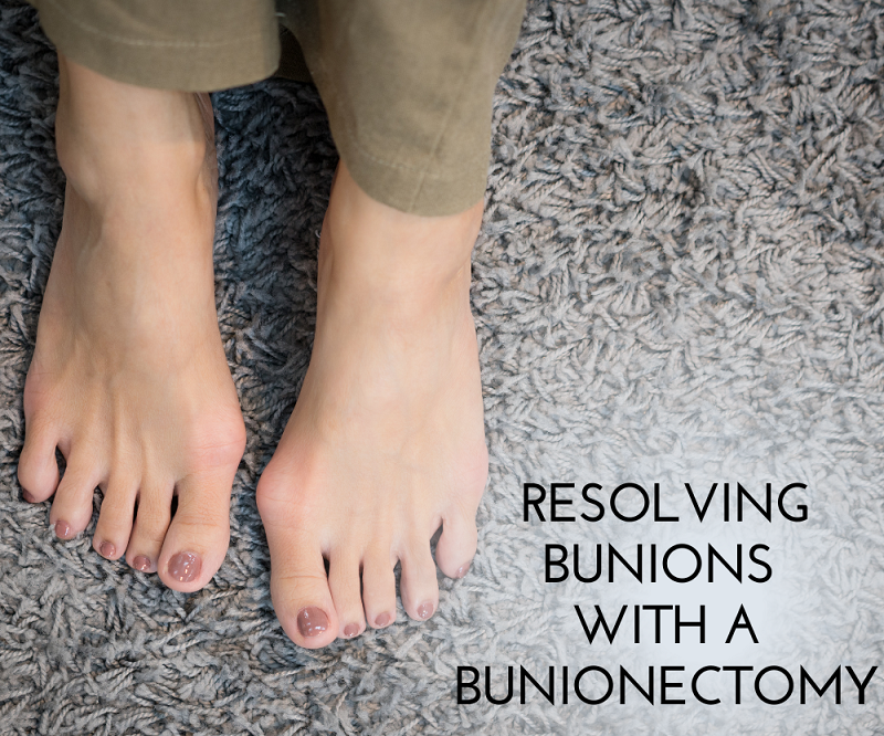 Resolving Bunions Through Bunionectomy: Restoring Comfort and Mobility ...
